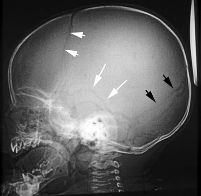 Radiographie du crâne et du massif facial – SFIPP